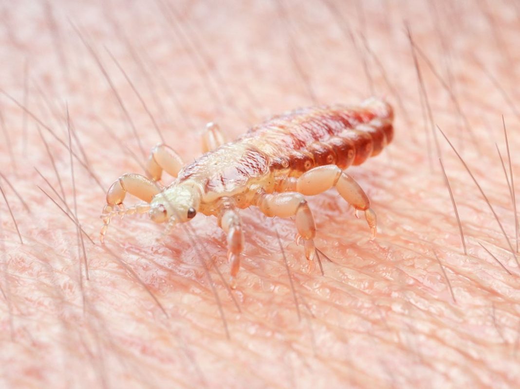 Lästig, aber harmlos: Läuse-Alarm in Schulen oder Kitas ist meistens ...